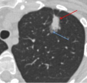 MGB Consensus on Pulmonary Nodule Management - Center for Evidence ...