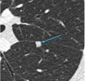 MGB Consensus on Pulmonary Nodule Management - Center for Evidence ...